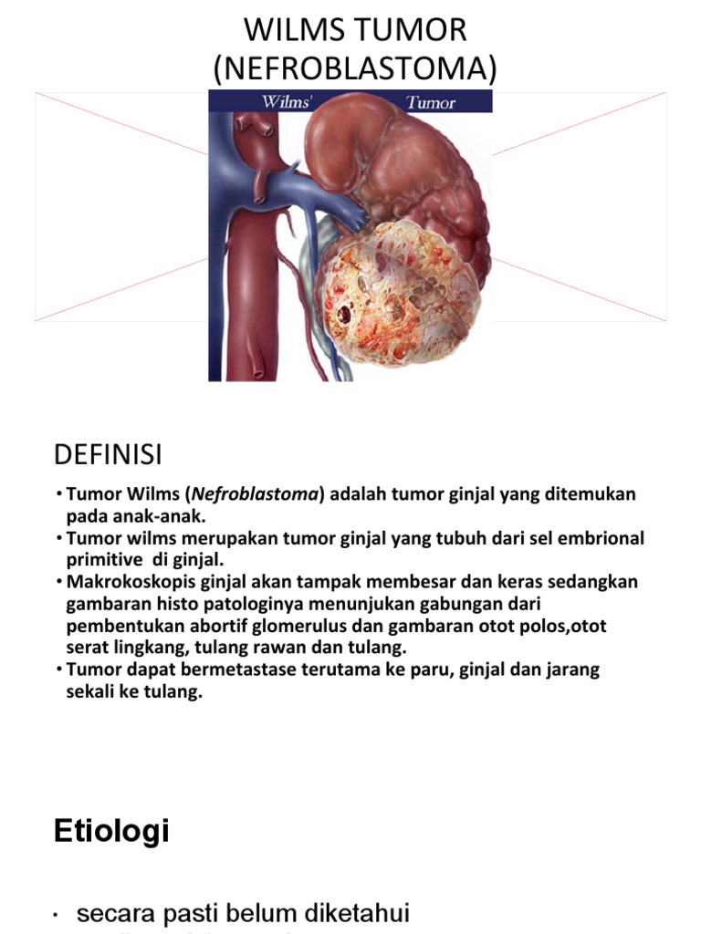 Wilms Tumor (Nefroblastoma) | PDF