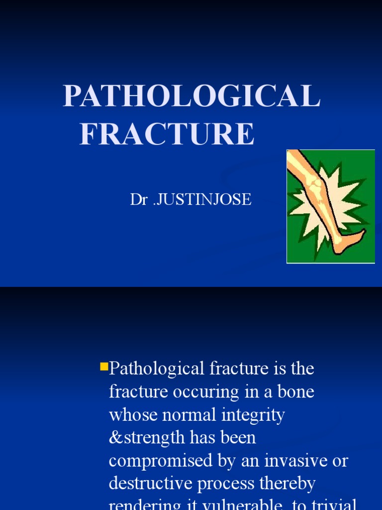 Understanding Pathological Fractures | PDF | Bone | Multiple Myeloma
