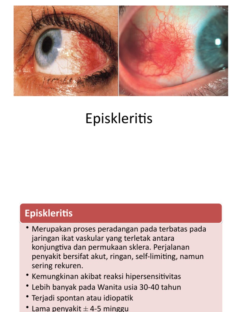 Episkleritis | PDF
