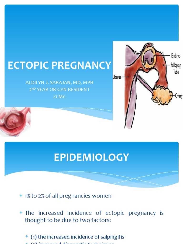 Ectopic Pregnancy: Causes and Risks | PDF | Pregnancy | Uterus