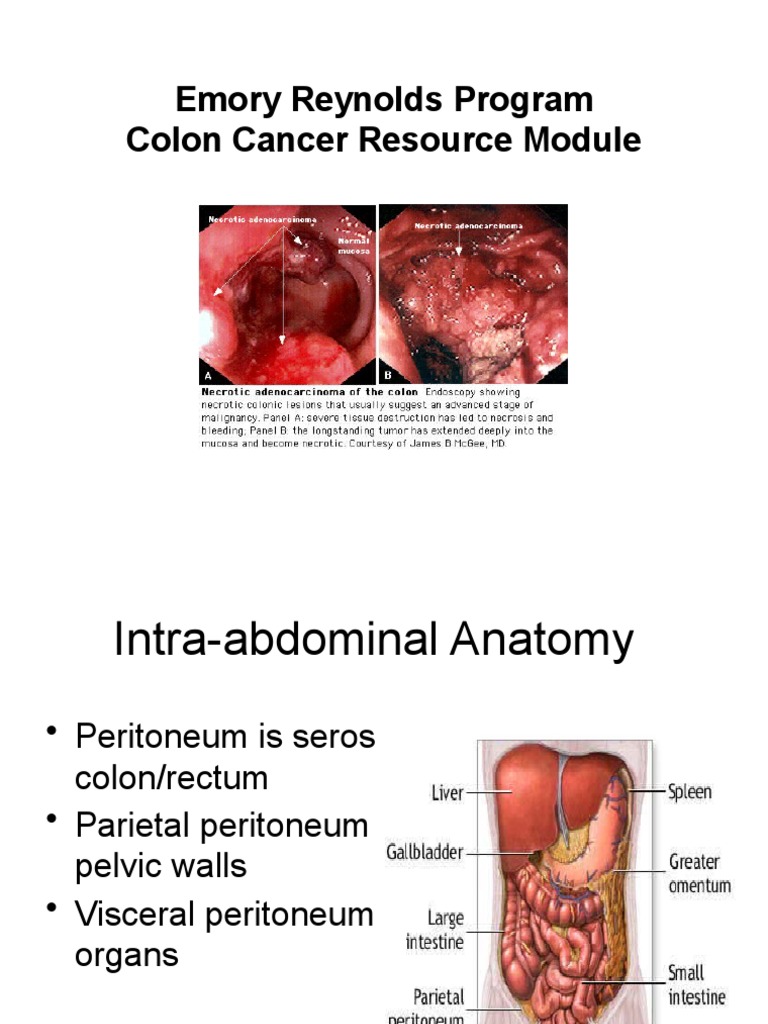 Colon Cancer | PDF | Colorectal Cancer | Colonoscopy