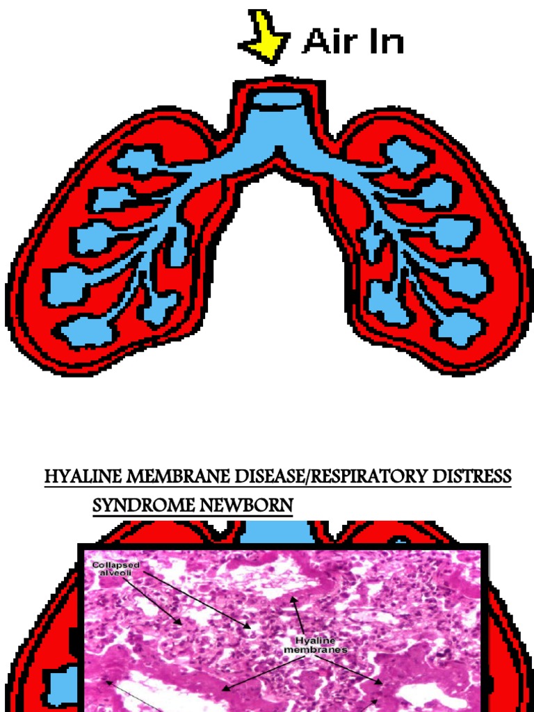 Hyaline Membrane Disease-1 | PDF | Medical Specialties | Clinical Medicine