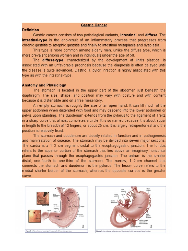 An In-Depth Look at Gastric Cancer: From Definition and Anatomy to ...