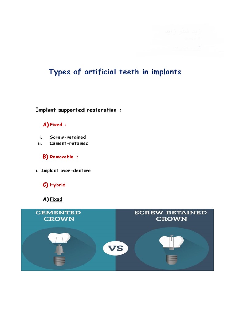 Types of Artificial Teeth in Implants | PDF | Dental Implant | Dentures