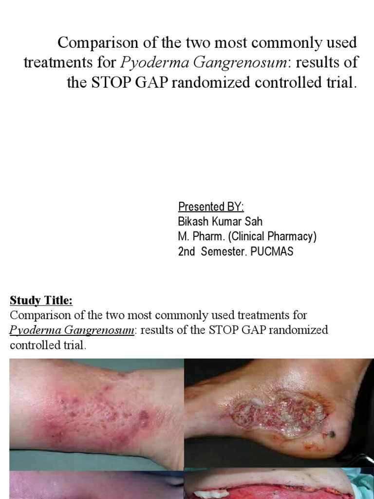 Pyoderma Gangrenosum | PDF | Randomized Controlled Trial | Comorbidity