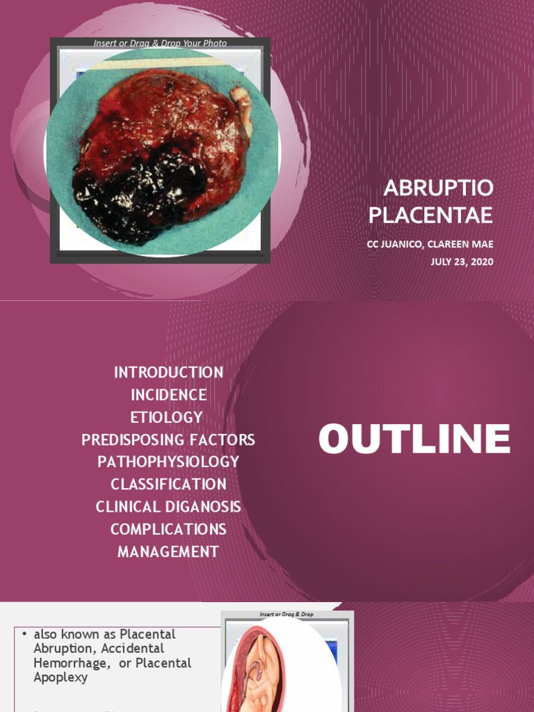 Abruptio Placentae: Insert or Drag & Drop Your Photo | PDF | Childbirth | Obstetrics