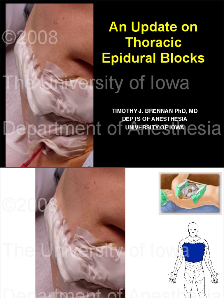 Thoracic Epidural Anesthesia Drugs