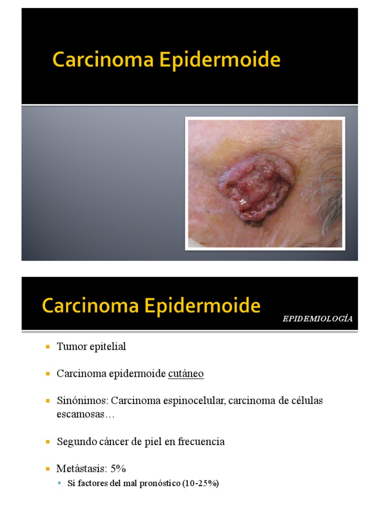 16 Carcinoma Epidermoide | PDF | Metástasis | Cáncer