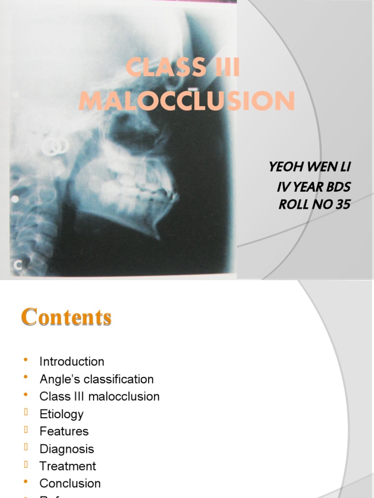 Class III Malocclusion Guide | PDF | Dentistry Branches | Health Sciences