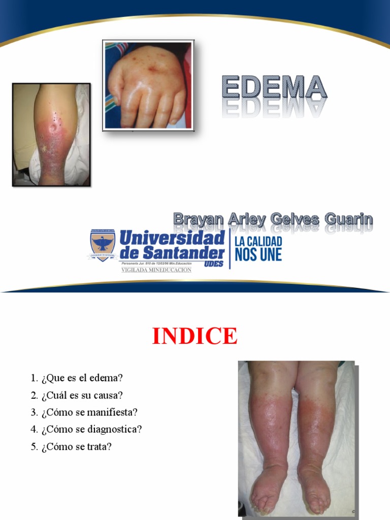 EDEMA | PDF | Edema | Insuficiencia cardíaca