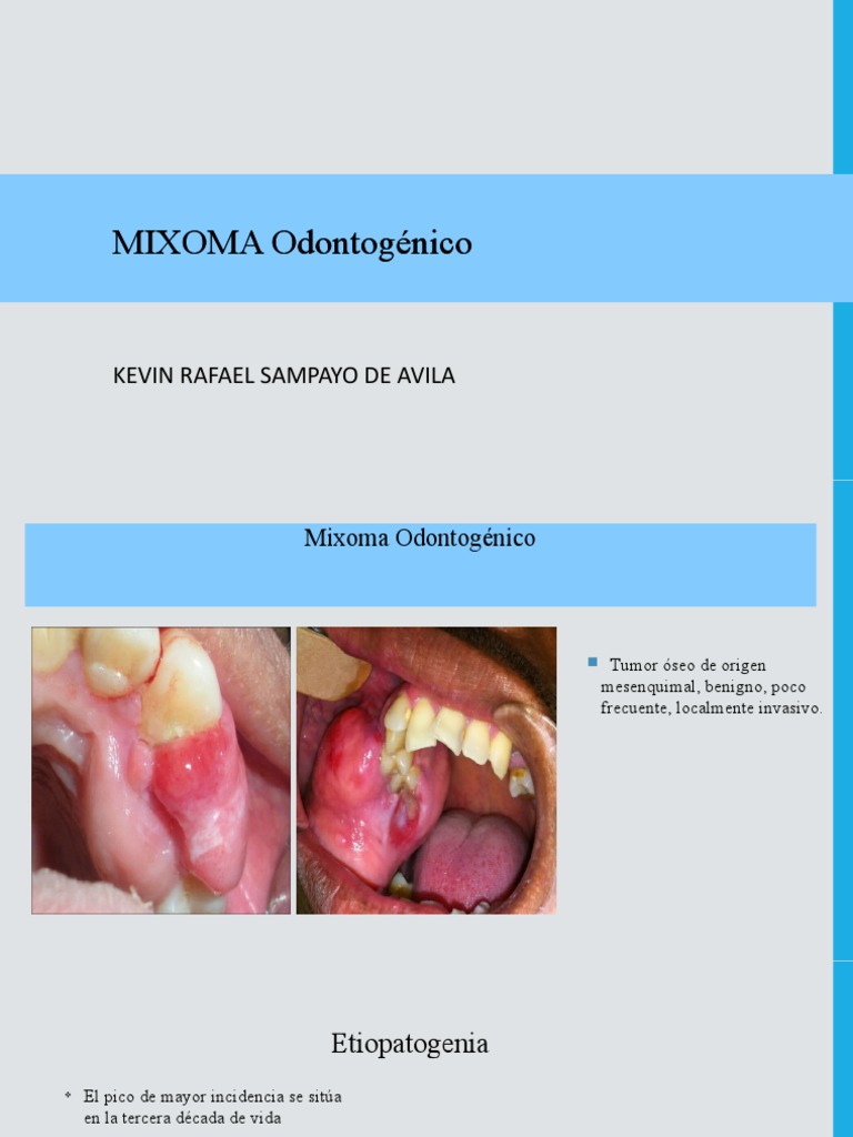 Mixoma Odontogenico Mixoma Odontogênico Tratamento Cirúrgico
