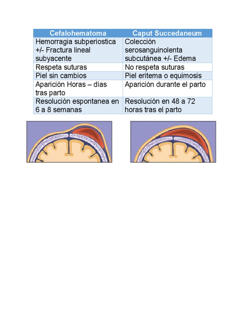 Cefalohematoma Vs Caput | PDF