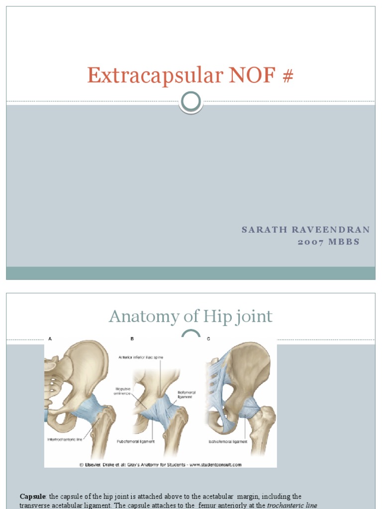 Extracapsular NOF #: Sarath Raveendran 2 0 0 7 M B B S | PDF | Hip ...
