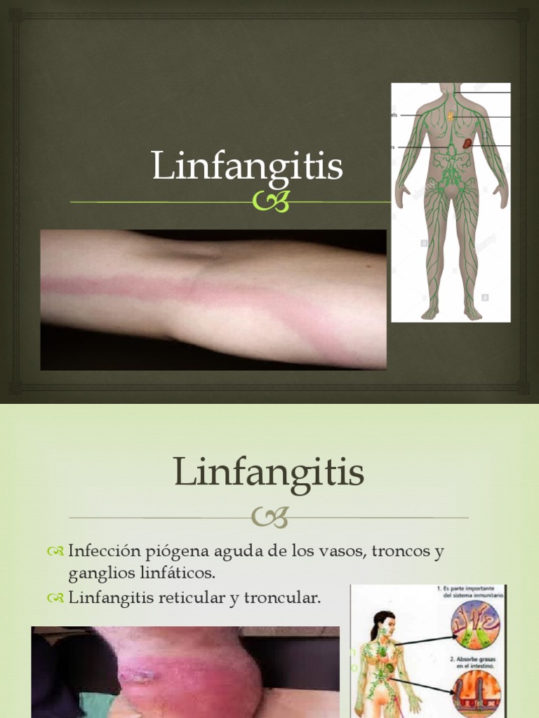 Linfangitis | Descargar gratis PDF | Septicemia | Ganglio linfático