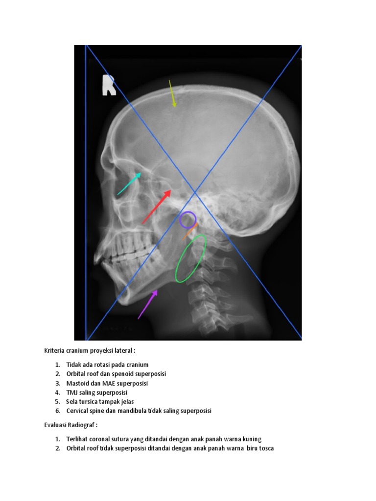 Kriteria Cranium Proyeksi Lateral | PDF