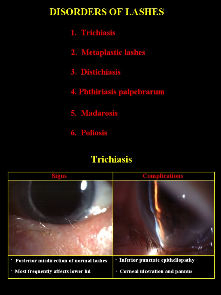 Disorders of Eyelashes: Trichiasis & Distichiasis | PDF | Diseases And ...