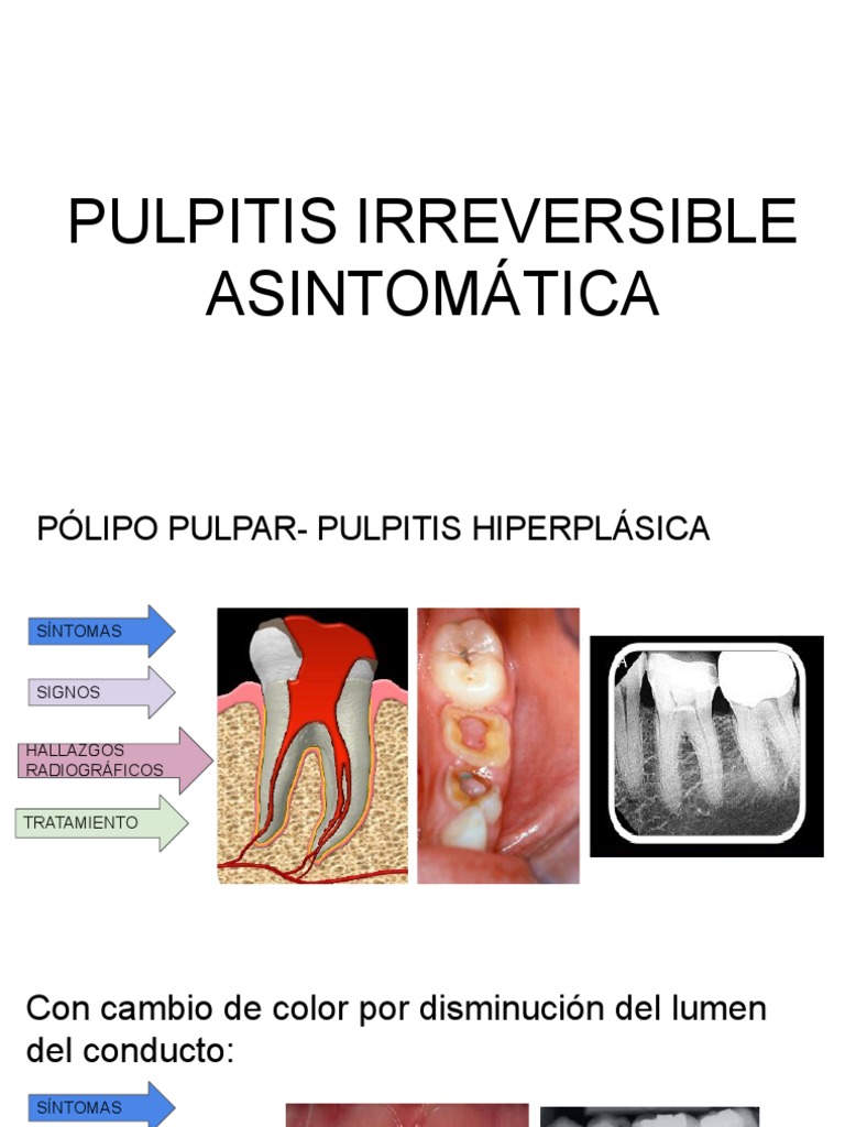 Pulpitis Irreversible | PDF