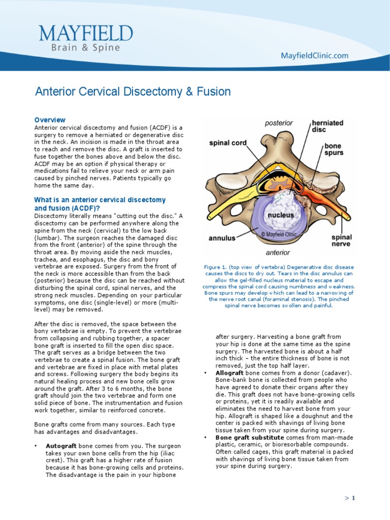 Anterior Cervical Discectomy & Fusion: Allograft Bone Comes From A ...