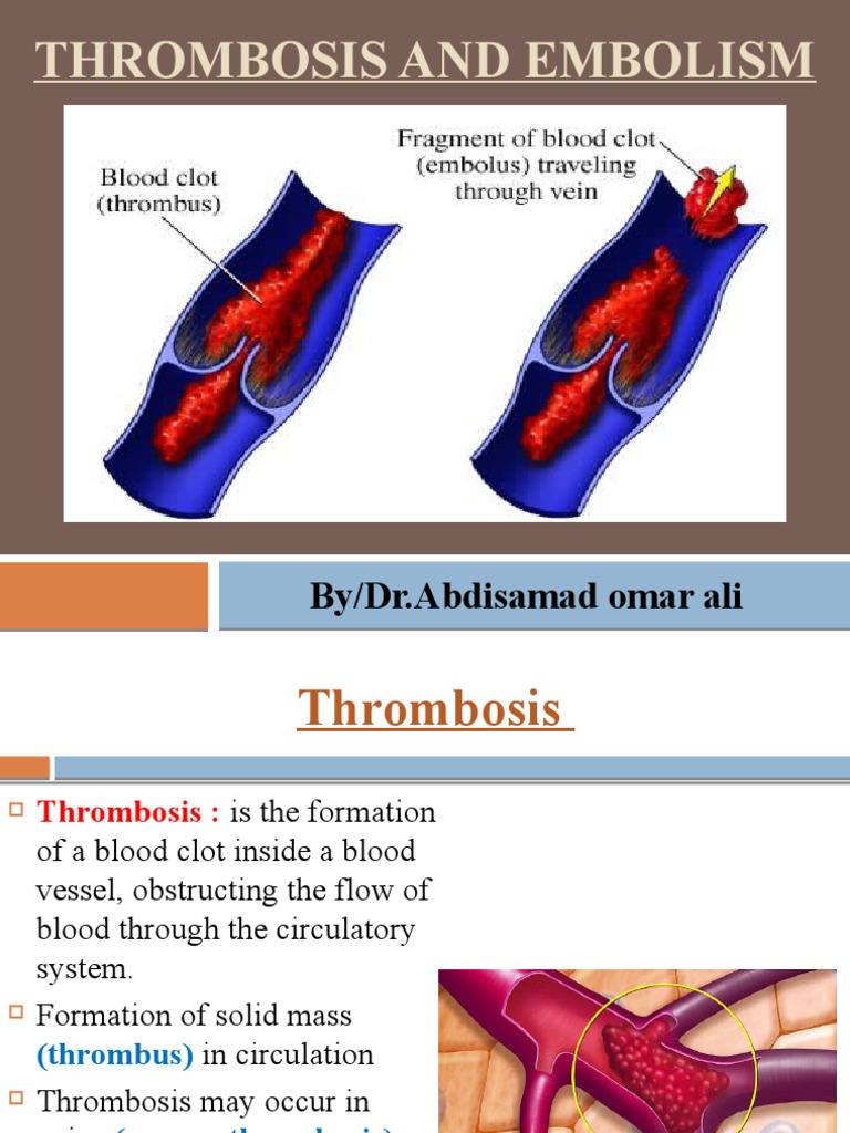 Thrombosis and Embolism Overview | PDF | Science & Mathematics