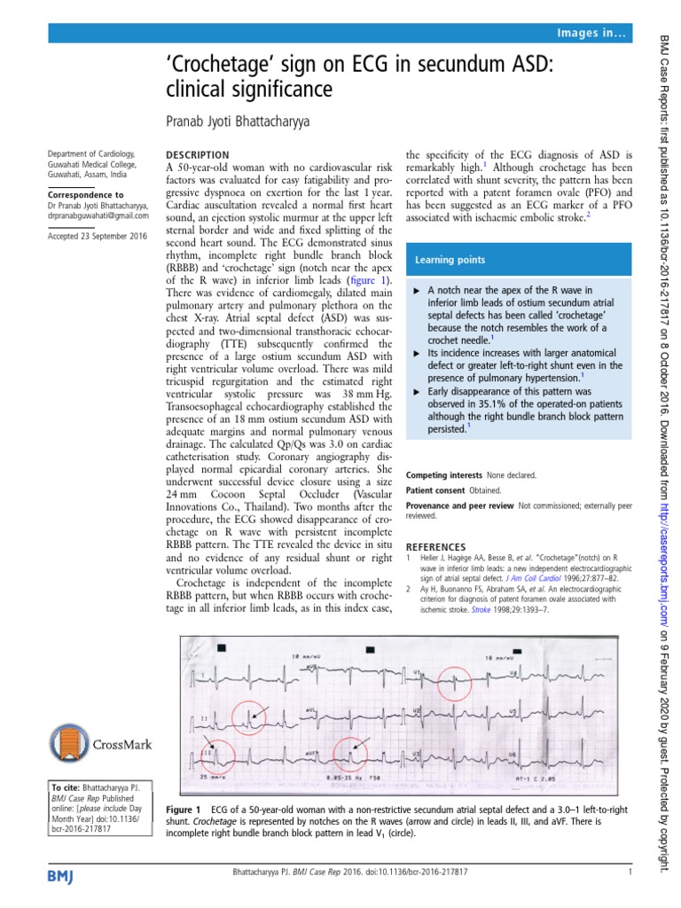 Crochetage' Sign On ECG in Secundum ASD | PDF | Thorax (Human Anatomy ...
