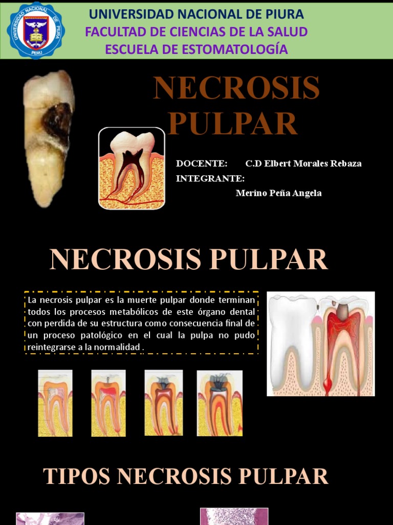 Necrosis Pulpar | PDF | Enfermedades y trastornos | Medicina CLINICA