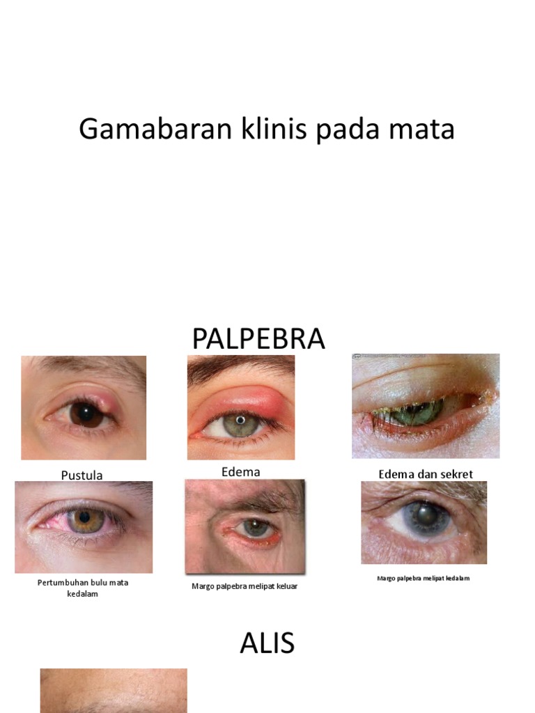 Gambaran Klinis Pada Mata | PDF