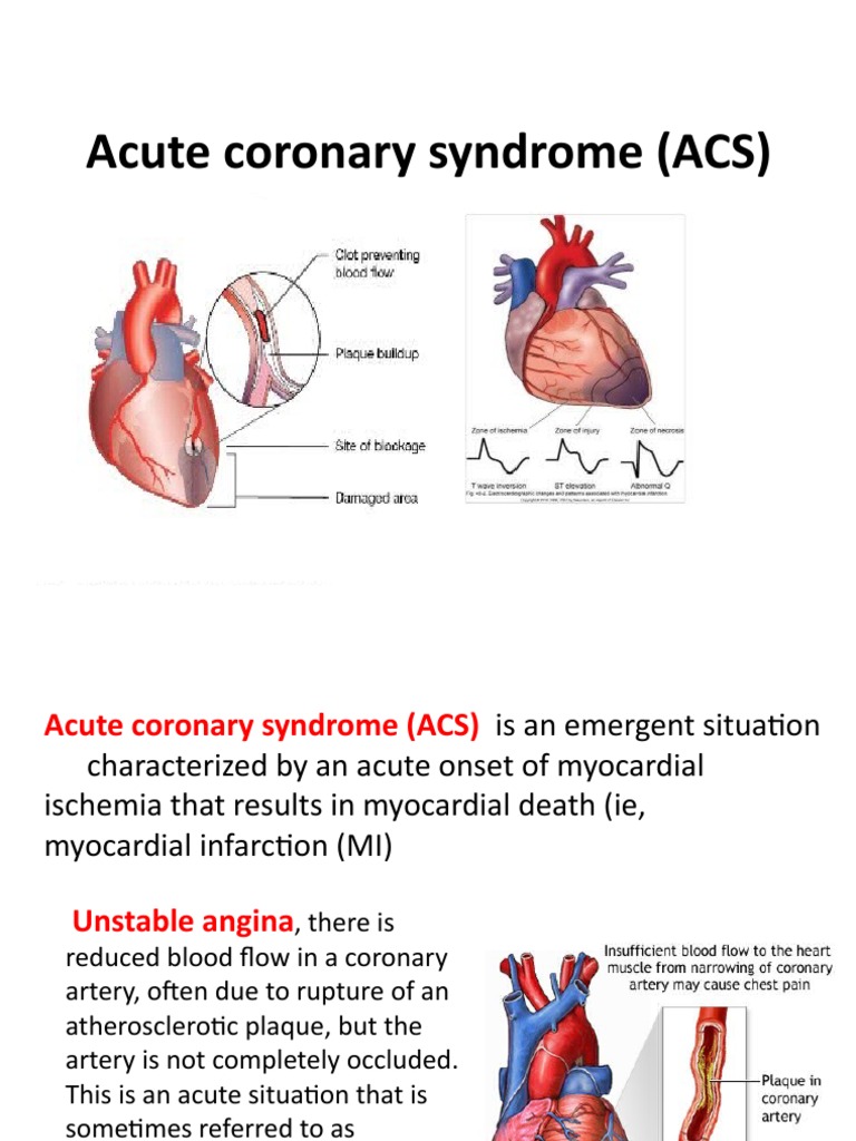 Acute Coronary Syndrome (ACS) | PDF | Myocardial Infarction | Heart