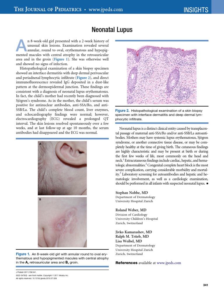 Lupus Neonatal | PDF | Systemic Lupus Erythematosus | Medical Specialties