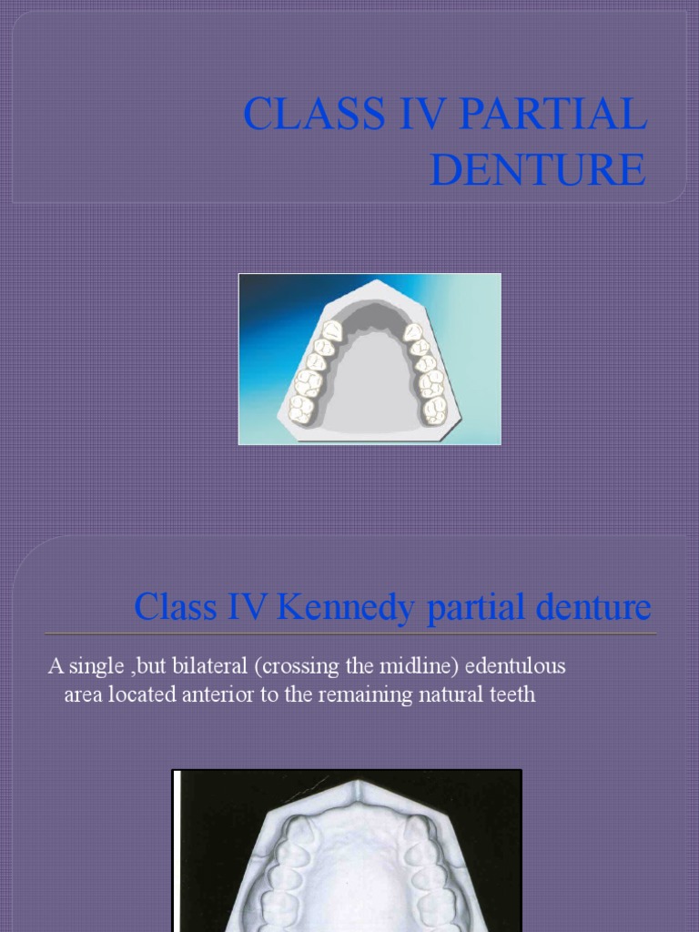 Class IV Kennedy Removable Partial Denture | PDF | Dentures | Mouth