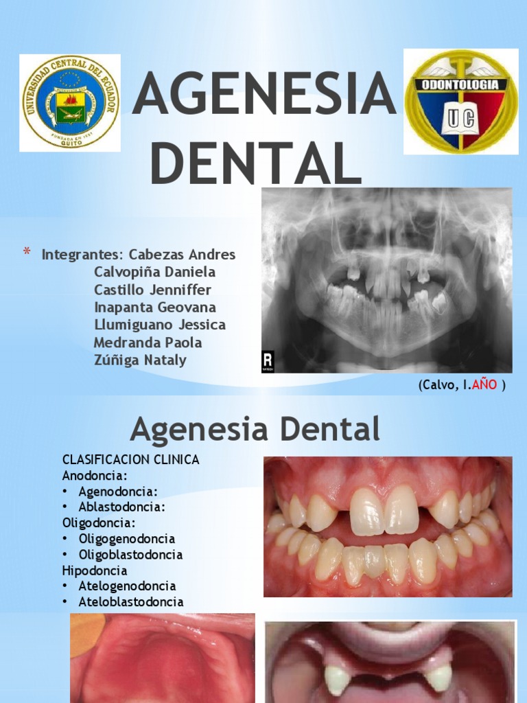 Agenesia Dental: Clasificación y Tratamiento | PDF | Diente | Odontología