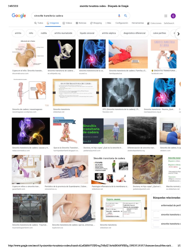 Sinovitis Transitoria Cadera | PDF | Ciencias de la Salud | Trastornos ...