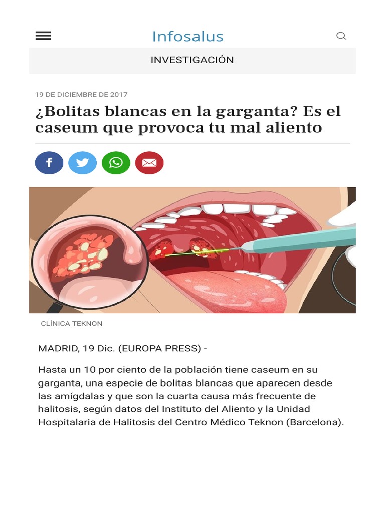 Noticia Bolitas Blancas Garganta Caseum Provoca Mal Aliento ...