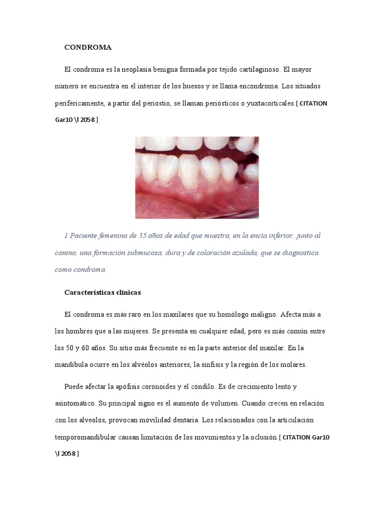 Condroma: Diagnóstico y Tratamiento | PDF | Cartílago | Hueso