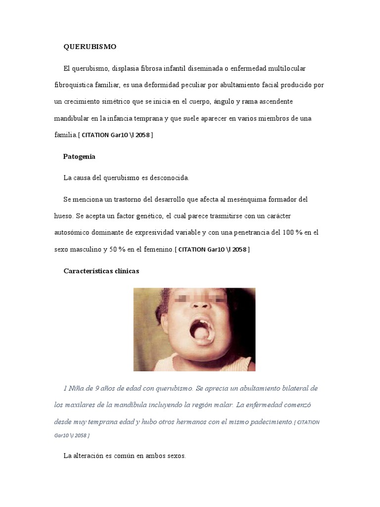 Enfermedad del querubismo: características clínicas, radiográficas y ...