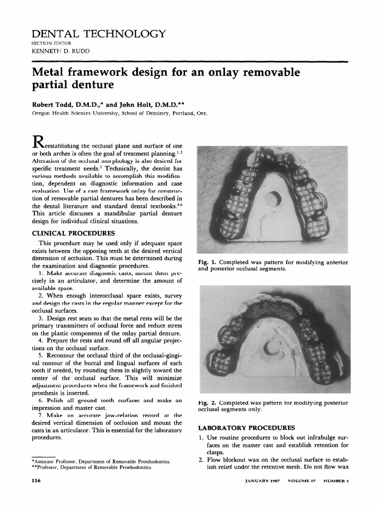 Metal Framework Design For An Onlay Removable Partial Denture | PDF ...