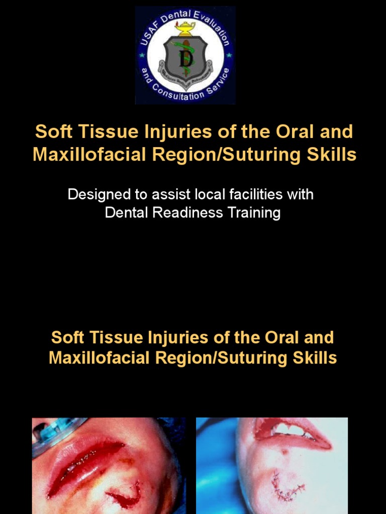 Soft Tissue Injuries of The Oral and Maxillofacial Region/Suturing ...
