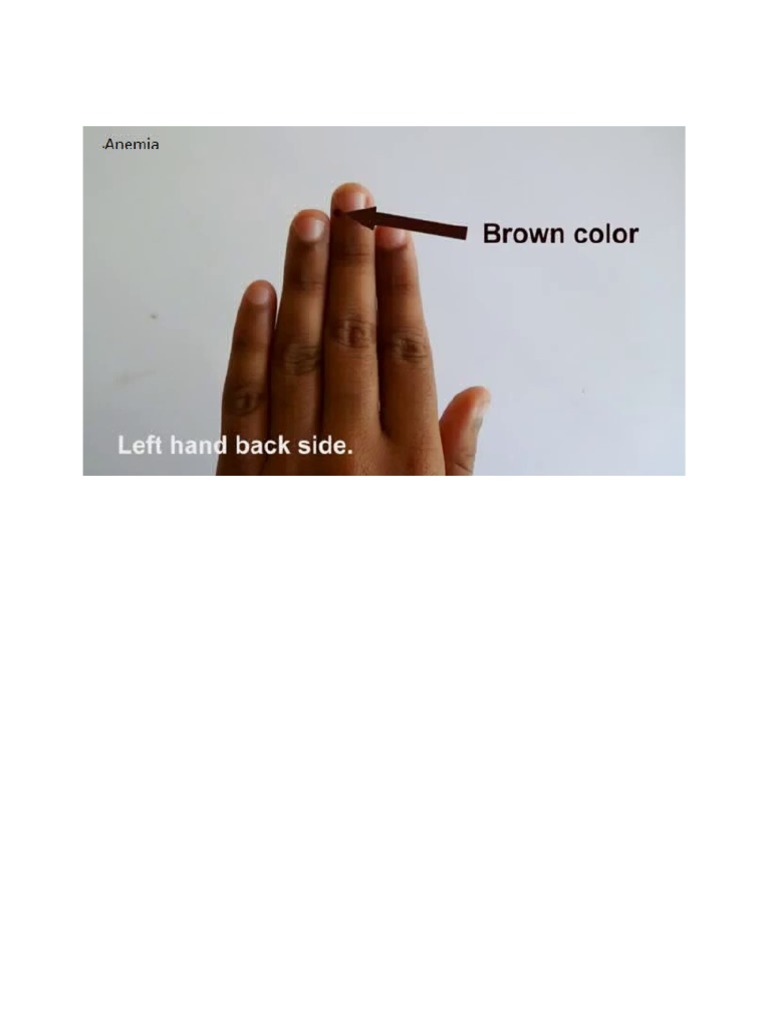 Anemia Color Therapy | PDF