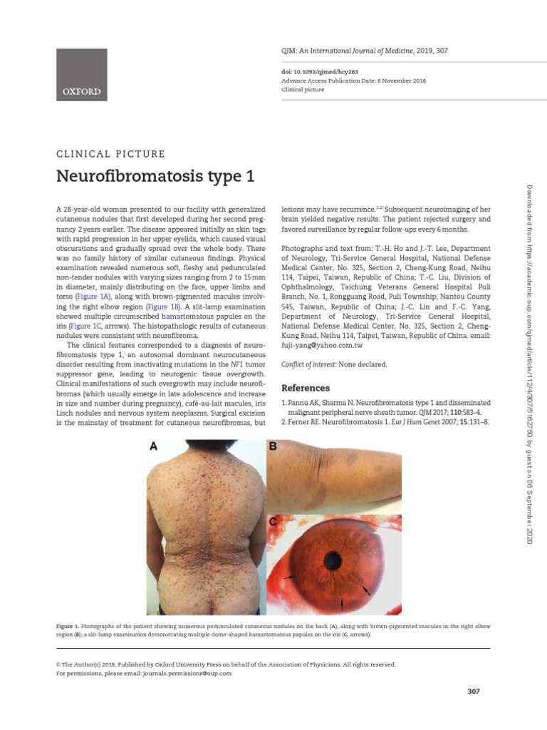 Neurofibromatosis Type 1: Clinicalpicture | PDF | Neoplasms | Diseases ...