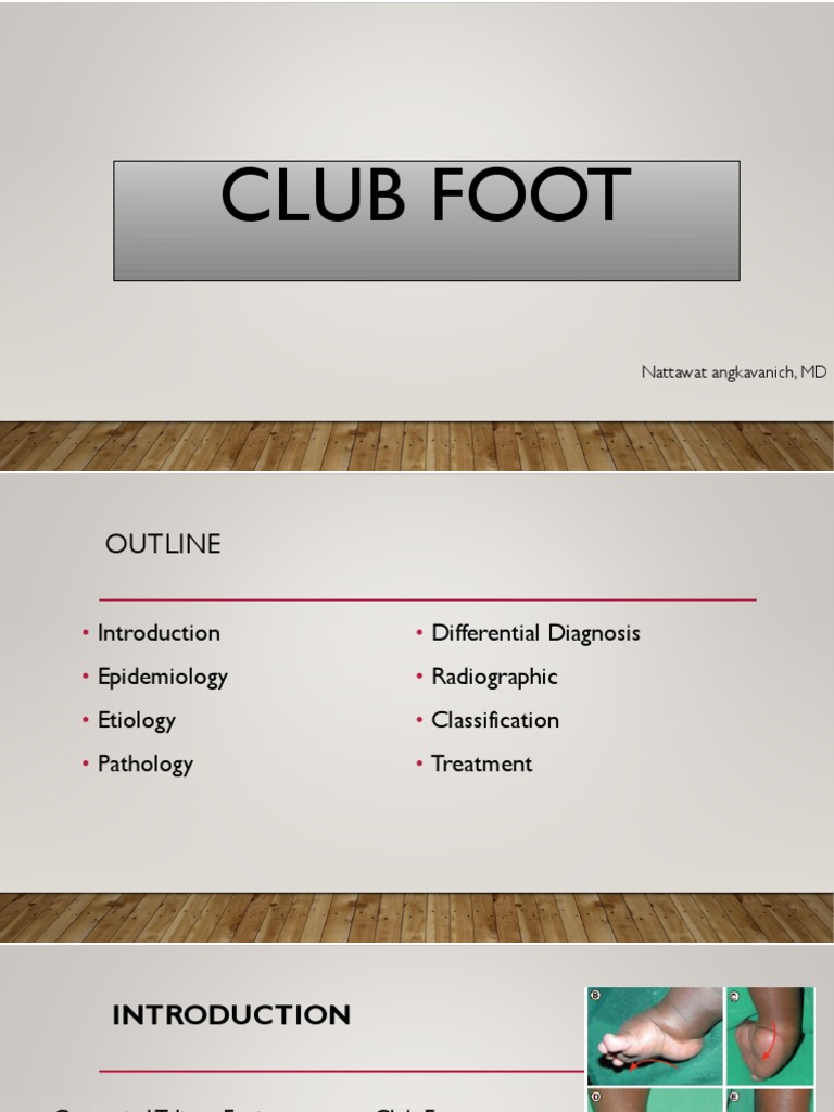 Club Foot PDF | PDF | Foot | Ankle