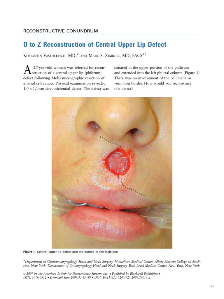 2007 O To Z Reconstruction of Central Upper Lip Defect | PDF | Lip ...
