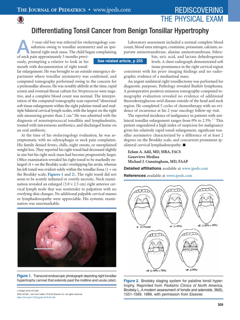 Differentiating Tonsil Cancer From Benign Tonsillar Hypertrophy | PDF ...