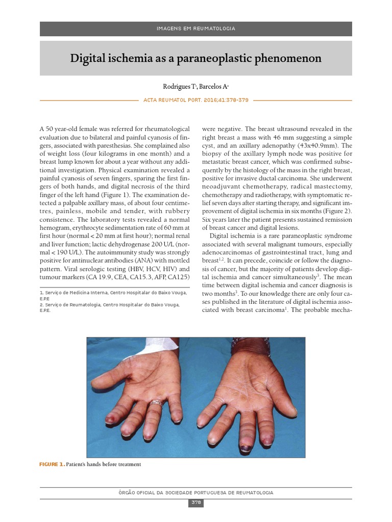 1085 Digital Ischemia As A Paraneoplastic Phenomenon File | PDF ...
