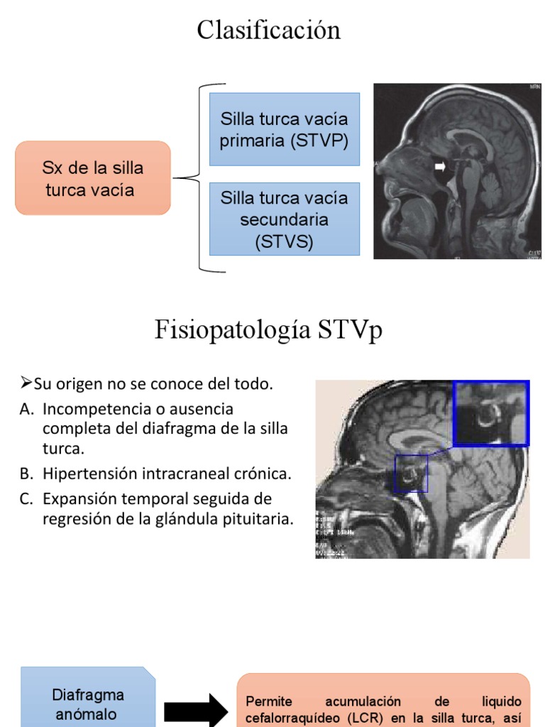 SX de La Silla Turca Vacía | PDF