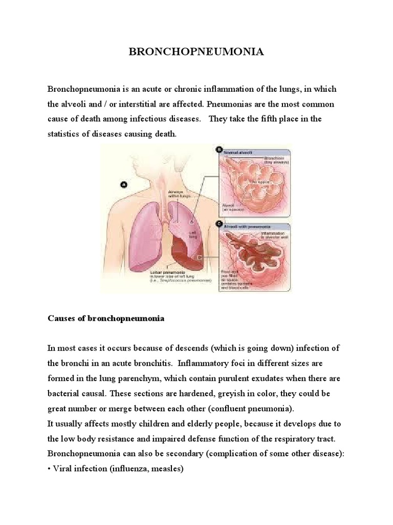 Causes of Bronchopneumonia | PDF | Pneumonia | Pulmonology