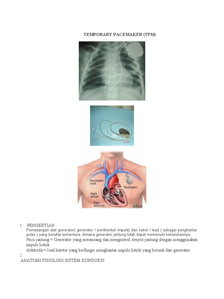 Temporary Pacemaker | PDF