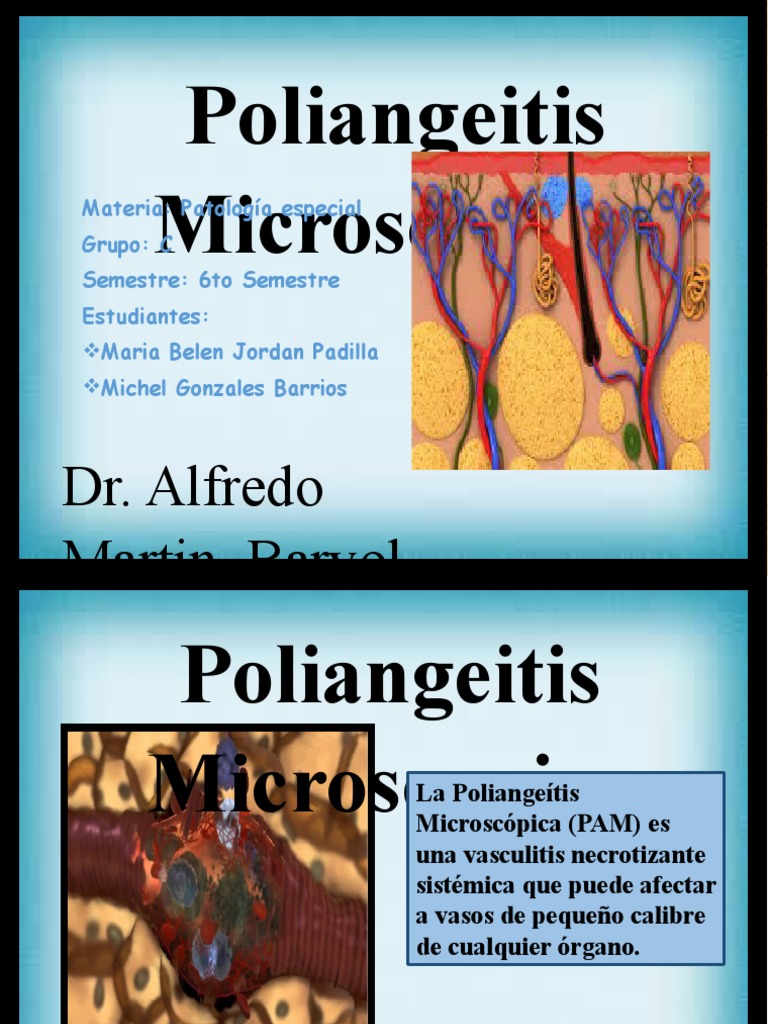 Poliangeítis Microscópica: Diagnóstico y Tratamiento | PDF ...