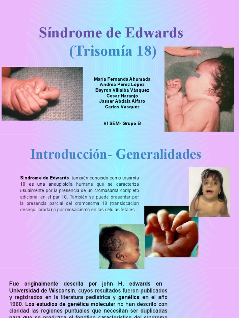 Sindrome de Edwards | PDF | Enfermedades y trastornos humanos | Biología