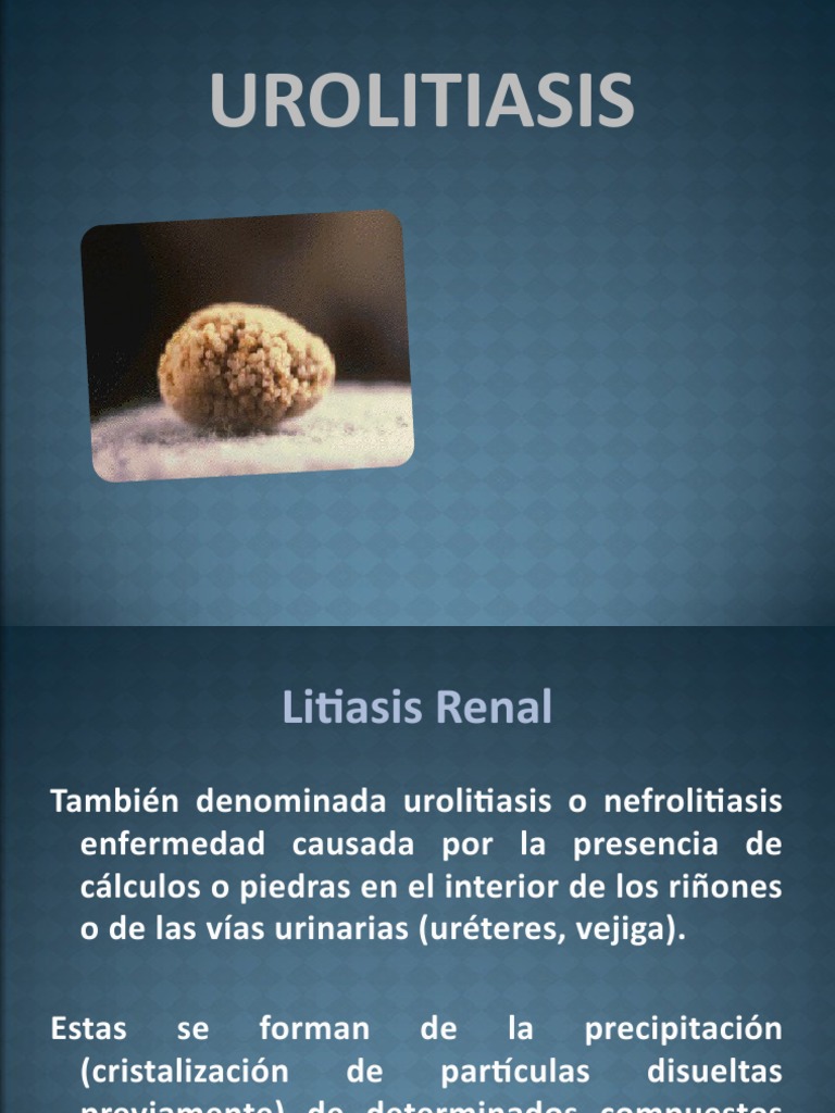 Urolitiasis Diplomado | PDF | Orina | Medicina CLINICA