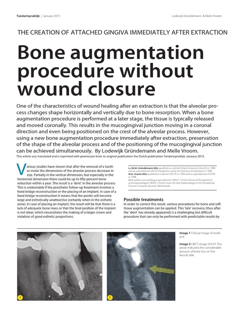 Bone Augmentation Procedure Without Wound Closure: The Creation of ...