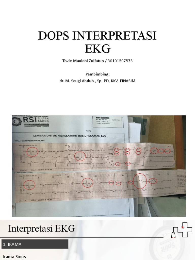 DOPS INTERPRETASI EKG Tiwi - Edit | PDF
